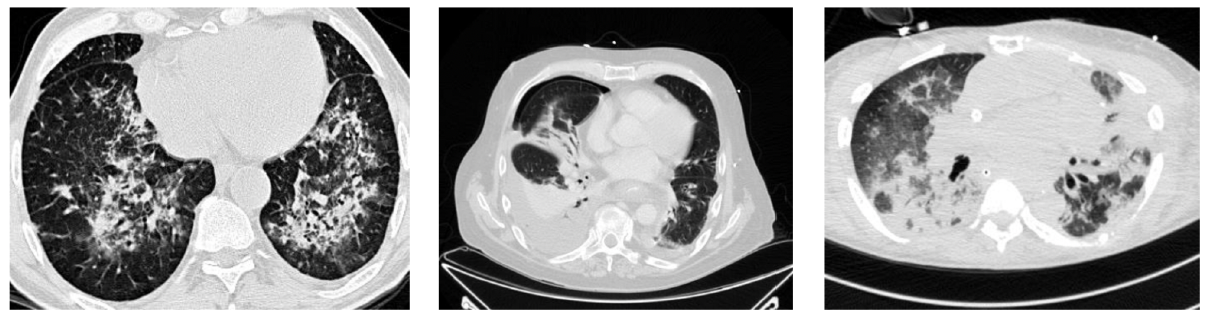 Achieving robust segmentation of lung regions in CT images irrespective to pathology