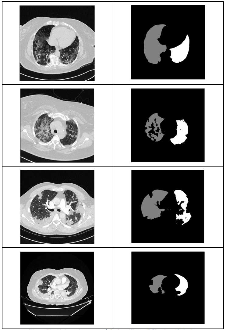 Achieving robust segmentation of lung regions in CT images irrespective to pathology